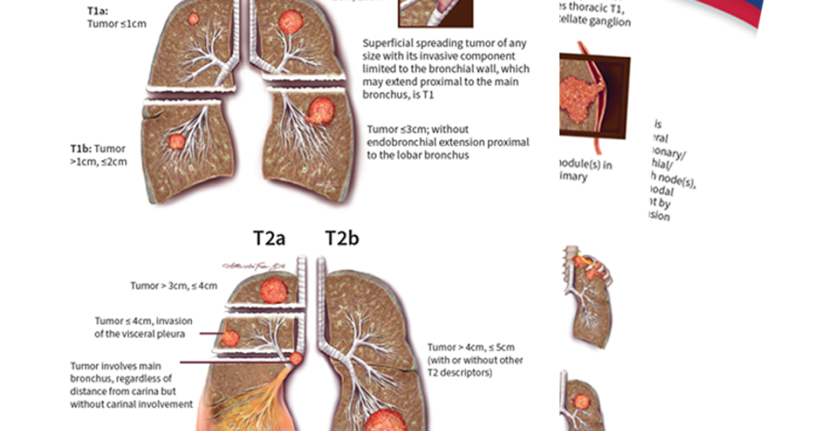 Staging Cards in Thoracic Oncology, 9th Edition | IASLC